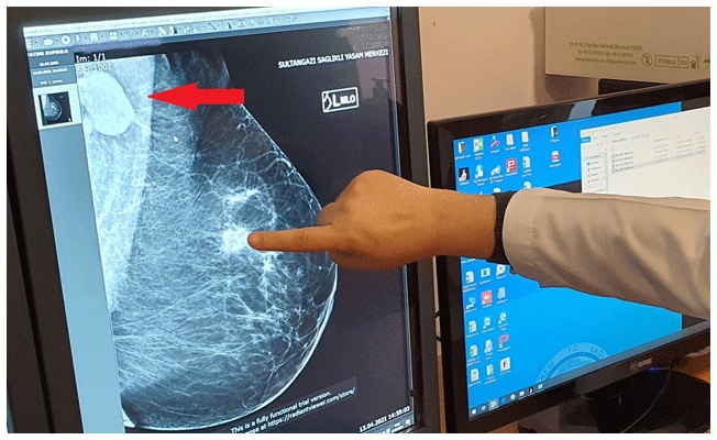 Lenf bezi tutulumu, meme kanseriyle karışabilir - Yeni Çağrı Gazetesi ...